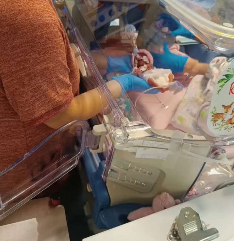 Bebê Que Nasceu Pesando 311 G E Com As Mãos Do Tamanho De Uma Unha